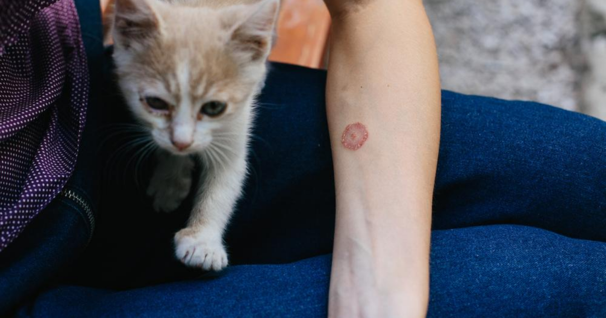 Itchy Red Circular Rash — It could be ringworm!