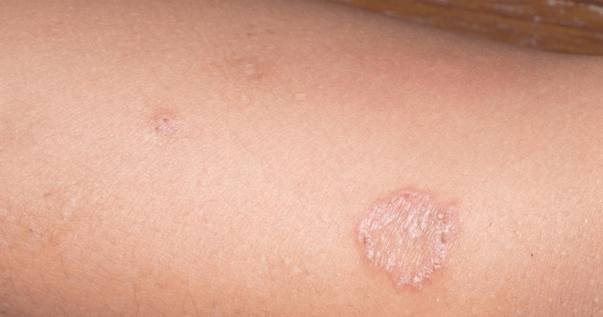 Itchy Red Circular Rash — It could be ringworm!