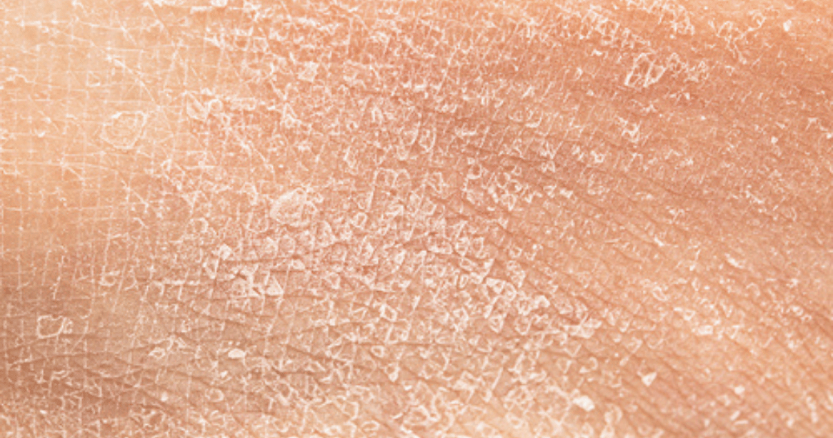 Ringworm or Dry Skin?