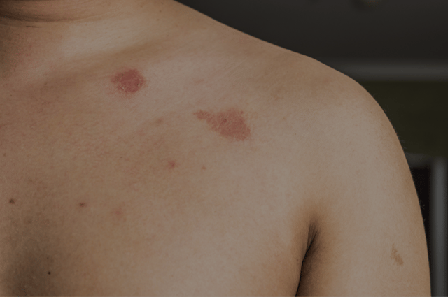 Is Ringworm Contagious?