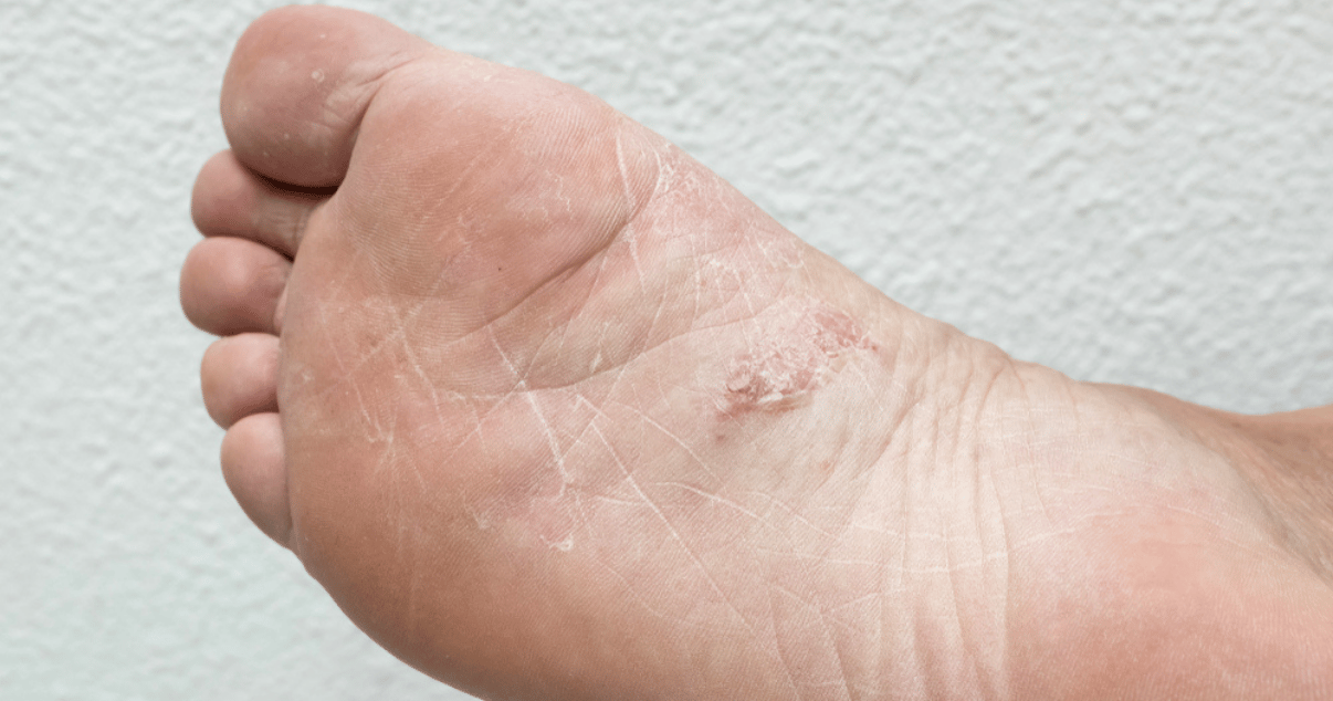 Athlete's Foot Symptoms or Dry Feet?
